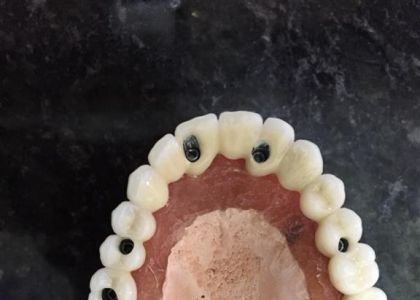 Casos Clínicos - Protocolo Cerâmico Sobre Implantes - Dr. Diego César ...