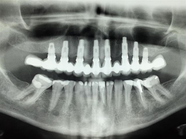 Casos Clínicos - Protocolo Cerâmico Sobre Implantes 2 - Dr. Diego César ...