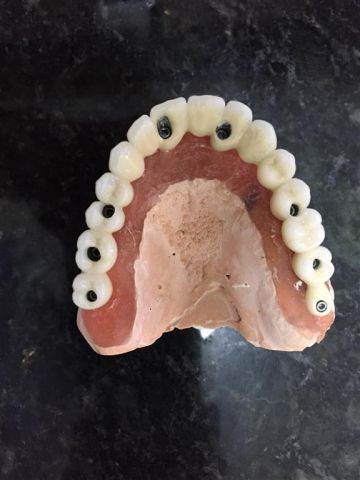 Casos Clínicos - Protocolo Cerâmico Sobre Implantes - Dr. Diego César ...