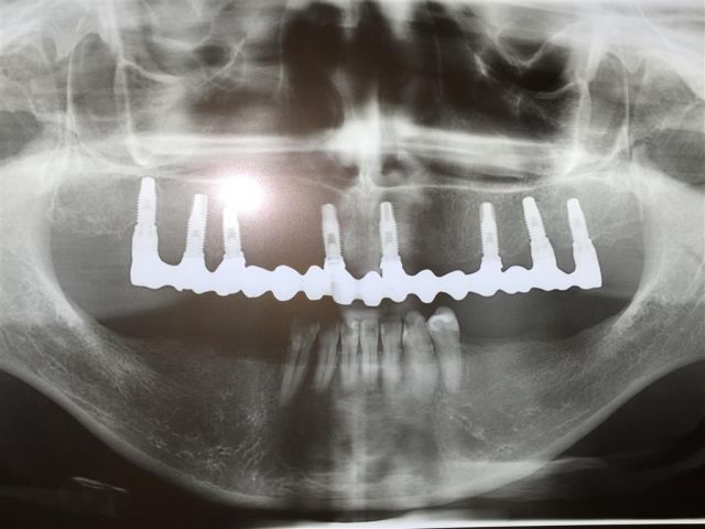 Casos Clínicos - Protocolo Cerâmico Sobre Implantes - Dr. Diego César ...