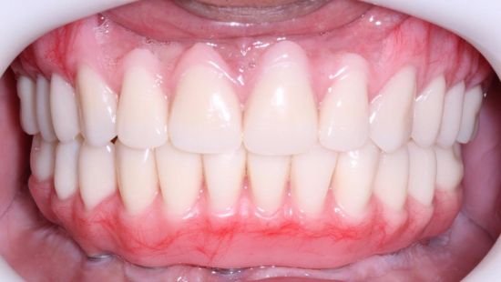 Casos Clínicos - Protocolo Cerâmico Sobre Implantes - Dr. Diego César ...