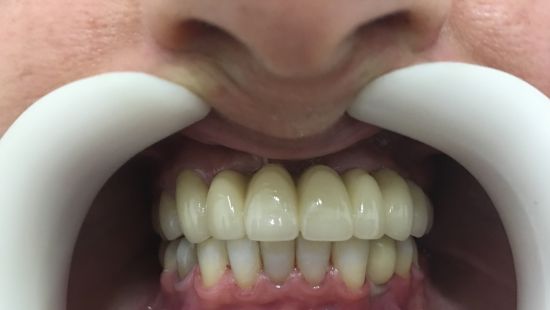 Casos Clínicos - Protocolo Cerâmico Sobre Implantes - Dr. Diego César ...